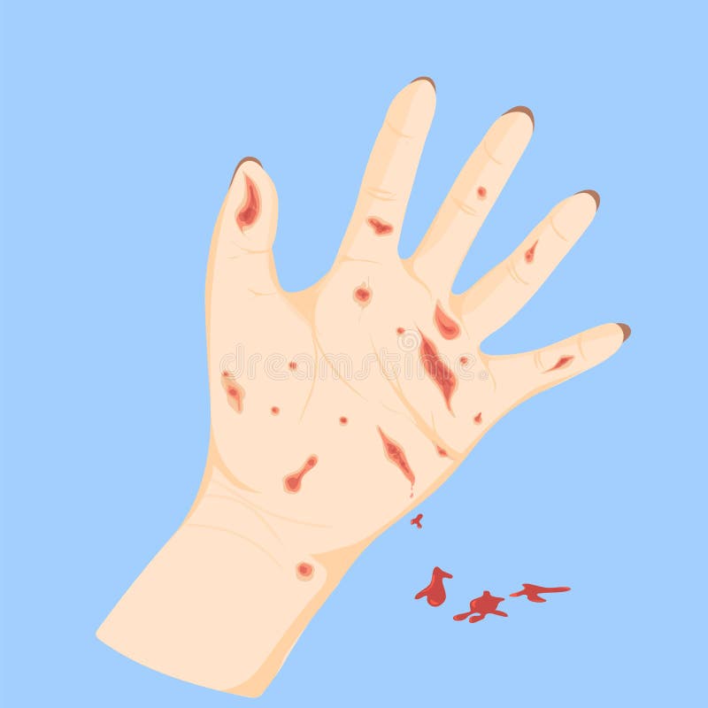 Wounded hand stock vector. Illustration of wound, flattened - 114276438