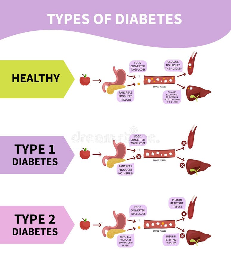 Vector Infographic Diabetes Stock Vector - Illustration of diabetes ...