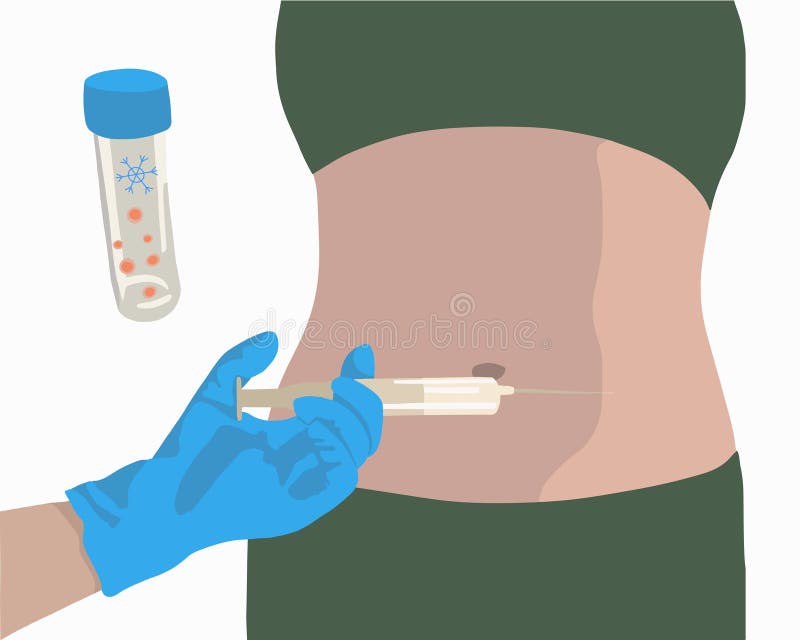 Vector Isolated Illustration of Ovulation Stimulation Process. Stock ...