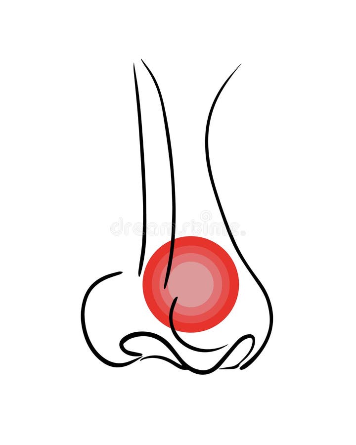 Nasal Congestion Stock Illustrations – 628 Nasal Congestion Stock ...