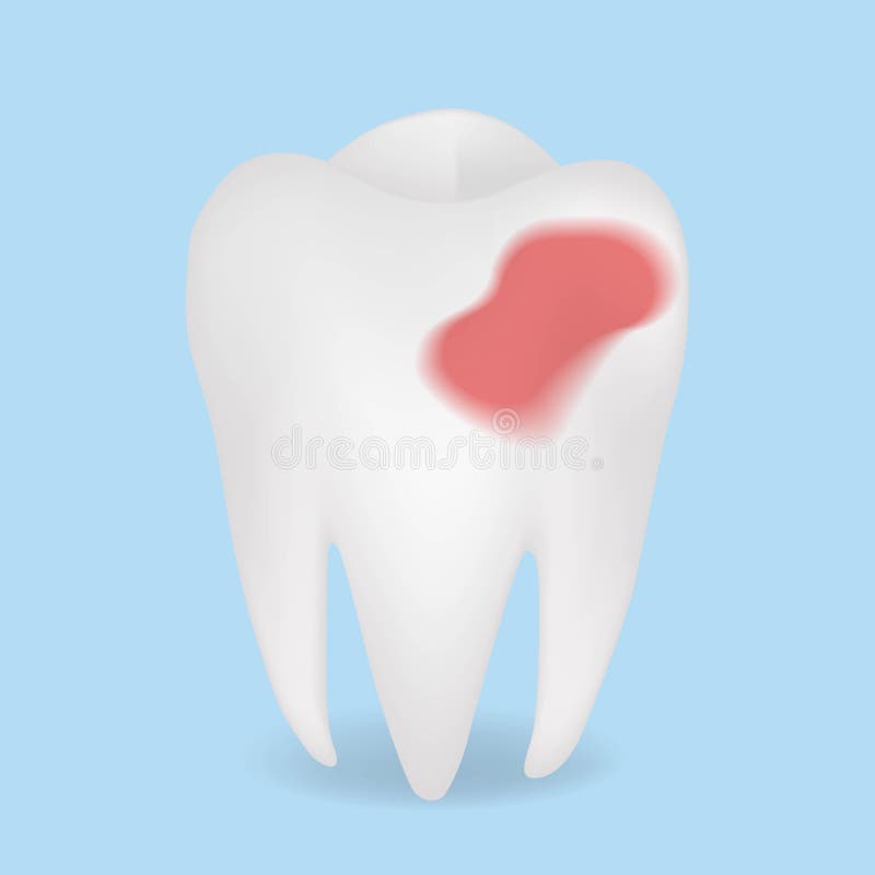 Vector Realistic Red Sick Tooth. Destroy Tooth Stock Vector ...