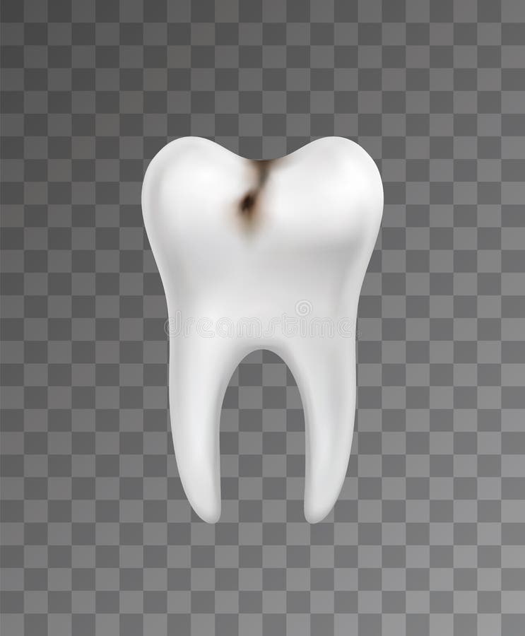 Vector White Tooth with Dental Caries on Transparent Background Stock ...