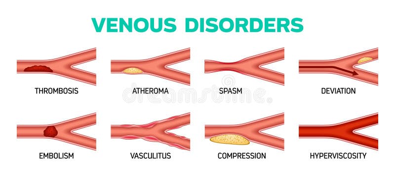Vein Disease, Venous Disorders Vector Infographics Stock Illustration ...