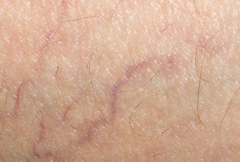 Varicose Veins On The Skin. Macro Stock Image - Image of illness ...