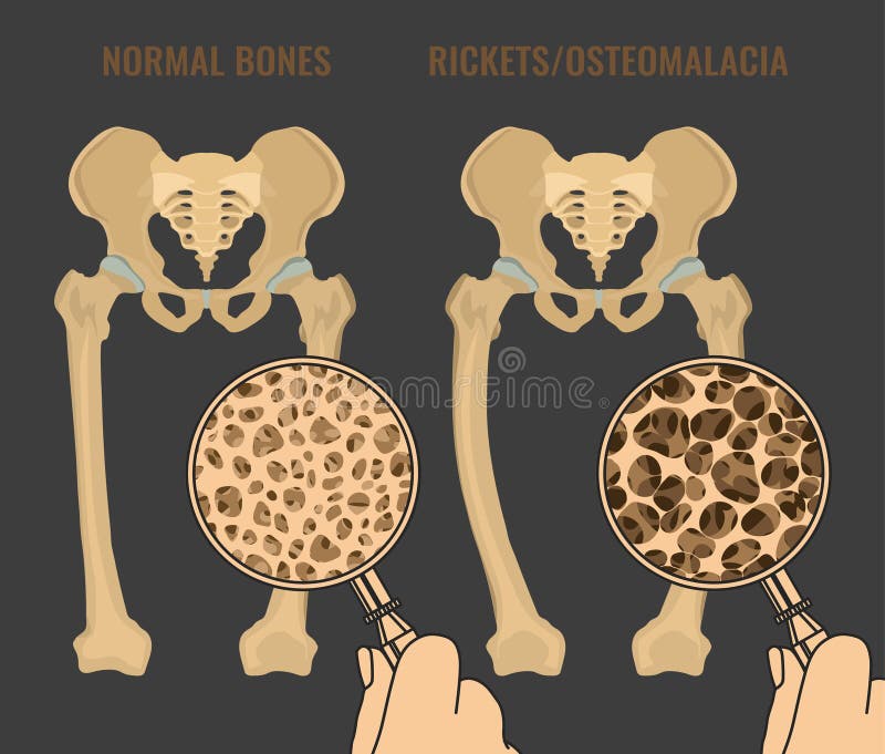 Rachitis-Osteomalazie stock abbildung. Illustration von schenkelbein ...
