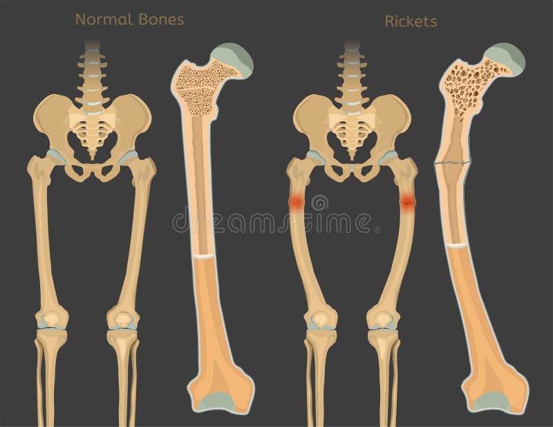 Rakitis-osteomalacia stock illustrationer. Illustration av spröd - 75699763
