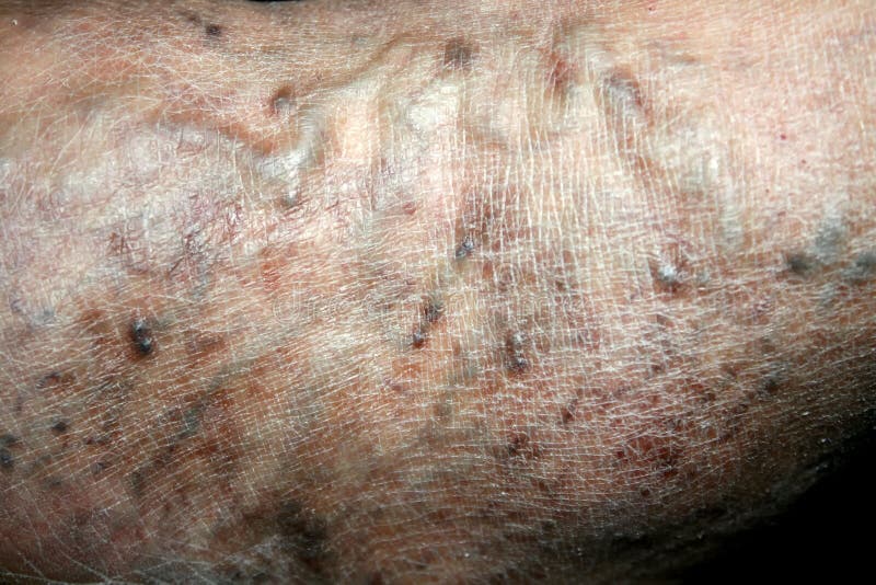 Vene Varicose Trombosi Piede Estensione Delle Vene Sulla Gamba Immagine ...