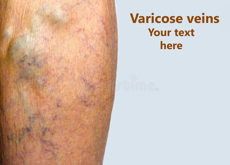 Vene varicose su una gamba fotografia stock. Immagine di lifestyle ...