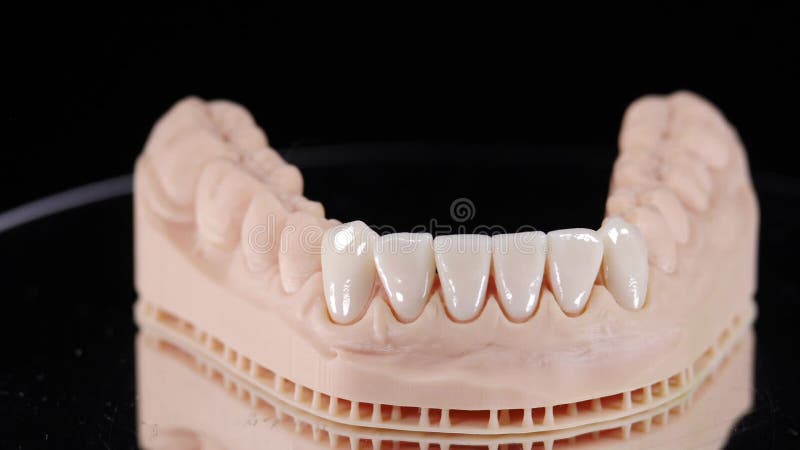 Veneers for Teeth on Jaw Model. Rotating on Black Background ...
