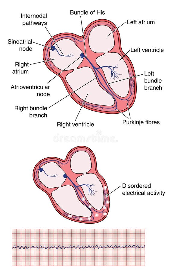 Ventricular Fibrillation Animation