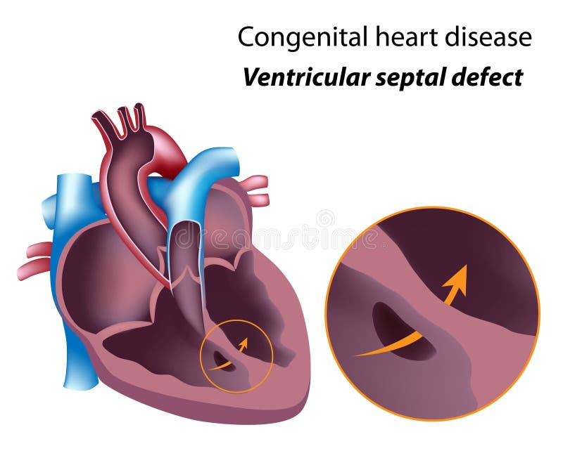 Ventricular septal defect stock vector. Illustration of hypertension ...
