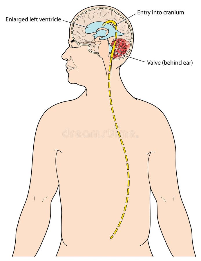 Ventriculoperitoneal Shunta Vektor Illustrationer - Illustration av öra ...
