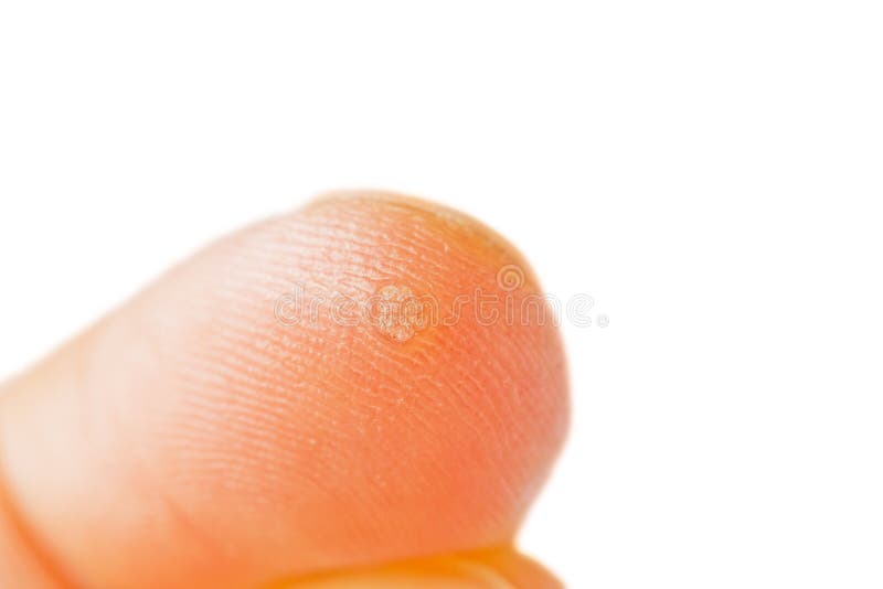 Verruca formation stock photo. Image of detailed, caucasian - 25313886
