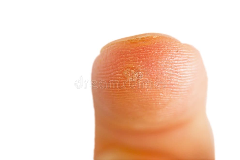 Verruca formation stock photo. Image of detailed, caucasian - 25313886