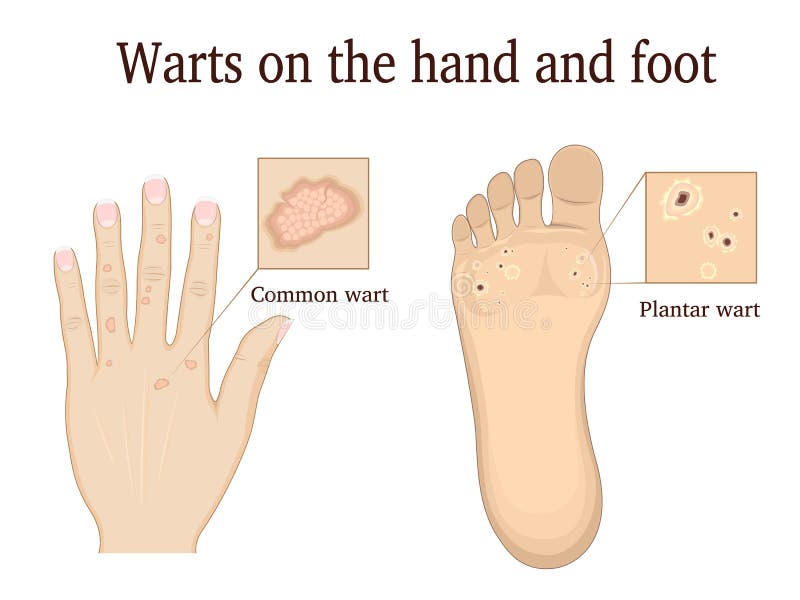 Verrues Sur La Main Et Le Pied Illustration de Vecteur - Illustration ...