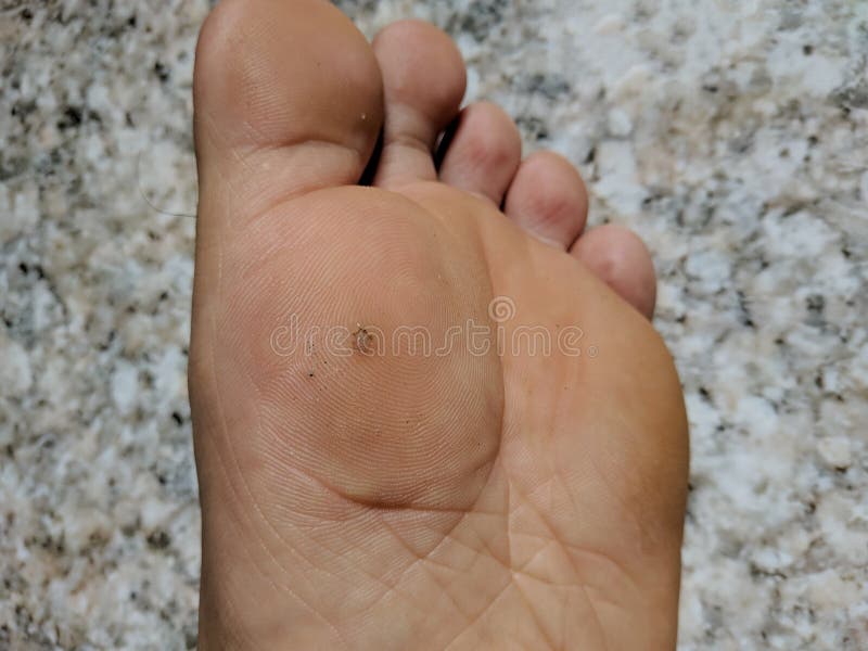 Pied, Verrues Plantaires, Maladie De La Peau, Dermatologie Image stock ...