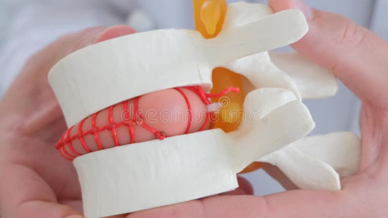 Vertebrologist Shows a Model of the Intervertebral Disc on Which a ...