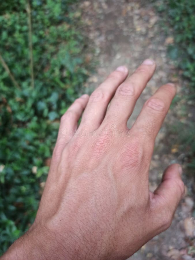 Hand Veins Popping Out