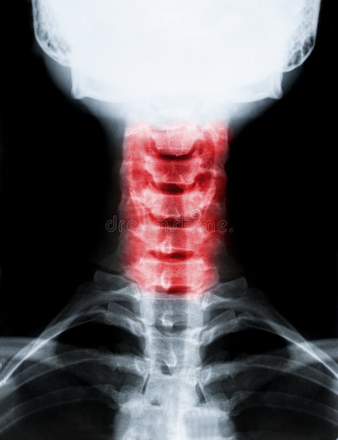 Vertical Shot of an X-ray Image of the Neck and Cervical Spine Stock ...