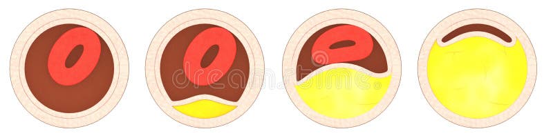 Vessels with Cholesterol Fat Stock Illustration - Illustration of heart ...