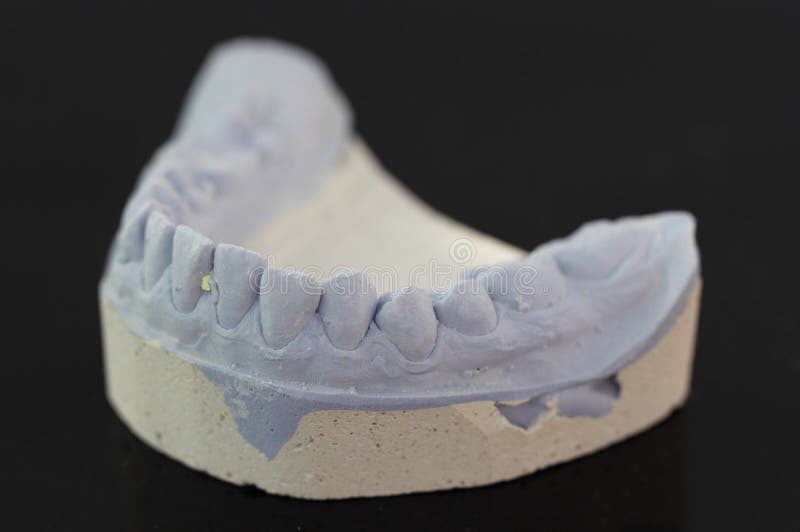 View of Plaster Model of Lower Front Teeth Stock Photo - Image of ...