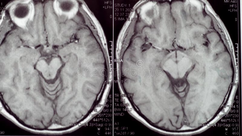 Viewing an MRI Image Showing a Defect in the Brain. Close-up. Slider ...