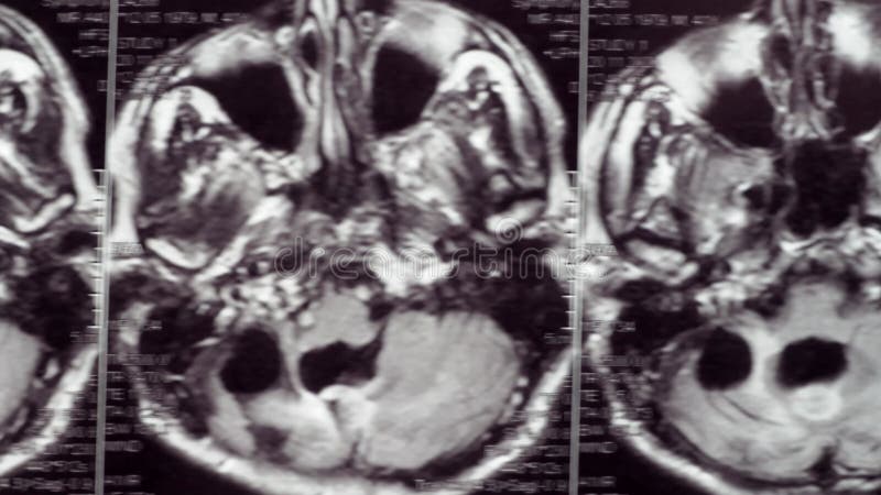 Viewing an MRI Image Showing a Defect in the Brain. Close-up. Slider ...