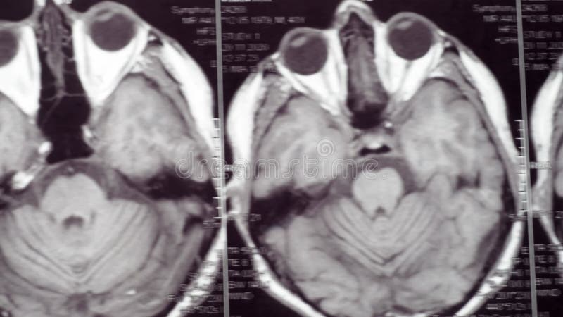 Viewing an MRI Image Showing a Defect in the Brain. Close-up. Slider ...