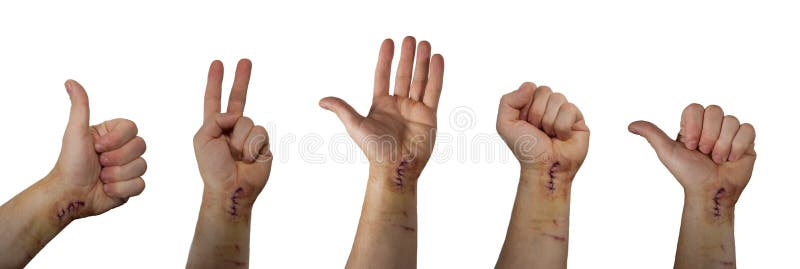 Views of the Hand with Fresh Scar Stock Photo - Image of surgery ...