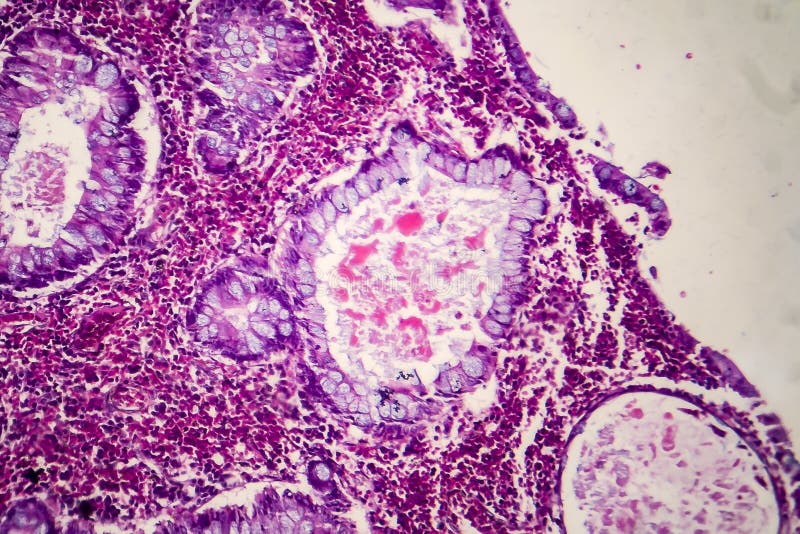 Villous Colon Adenocarcinoma, Light Micrograph Stock Photo - Image of ...