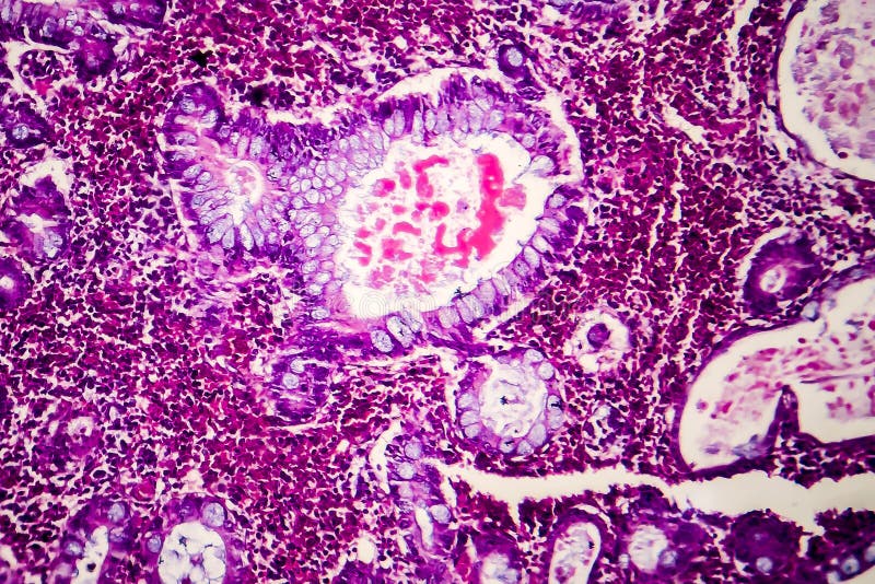 Villous Colon Adenocarcinoma, Light Micrograph Stock Photo - Image of ...