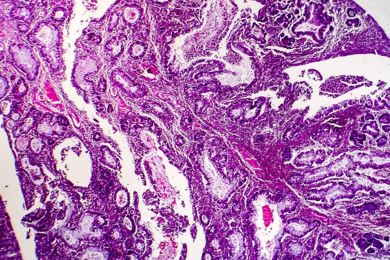 Villous Colon Adenocarcinoma, Light Micrograph Stock Photo - Image of ...