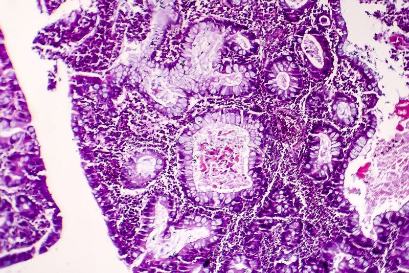 Villous Colon Adenocarcinoma, Light Micrograph Stock Photo - Image of ...