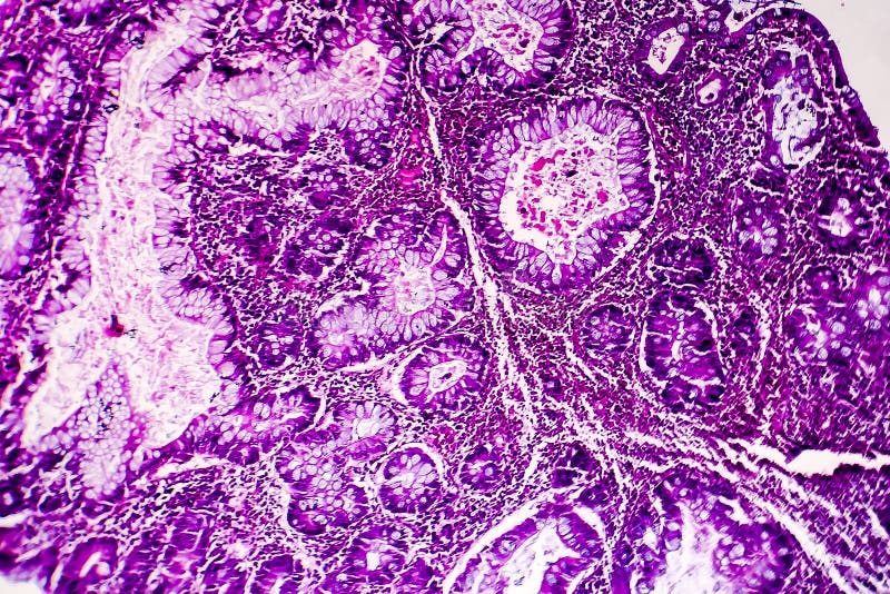 Villous Colon Adenocarcinoma, Light Micrograph Stock Photo - Image of ...