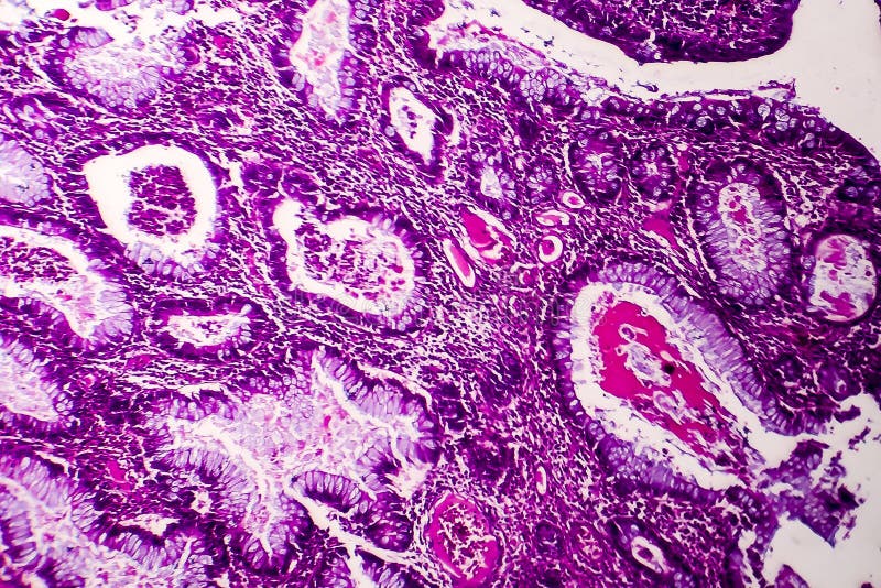 Villous Colon Adenocarcinoma, Light Micrograph Stock Image - Image of ...