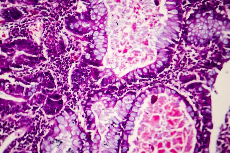 Villous Colon Adenocarcinoma, Light Micrograph Stock Photo - Image of ...