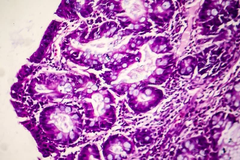 Colon Adenocarcinoma, Cancer Of Colon Stock Image - Image of ...