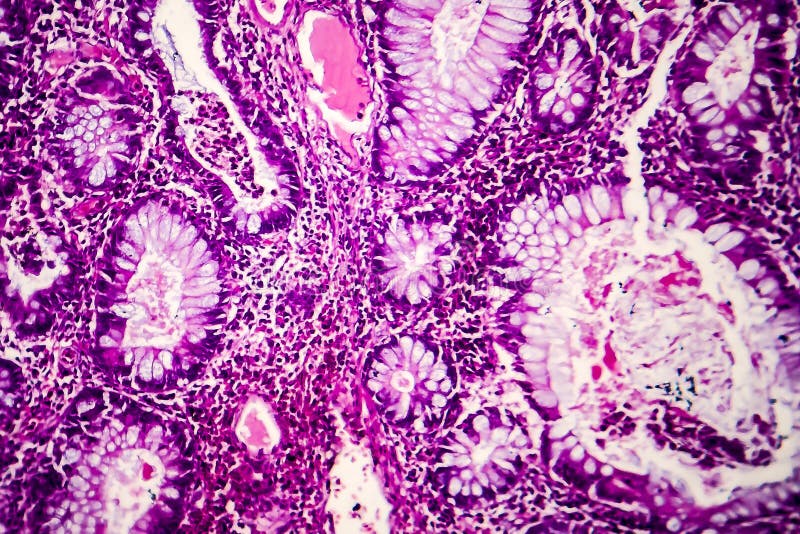 Villous Colon Adenocarcinoma, Light Micrograph Stock Image - Image of ...