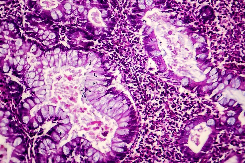 Villous Colon Adenocarcinoma, Light Micrograph Stock Image - Image of ...