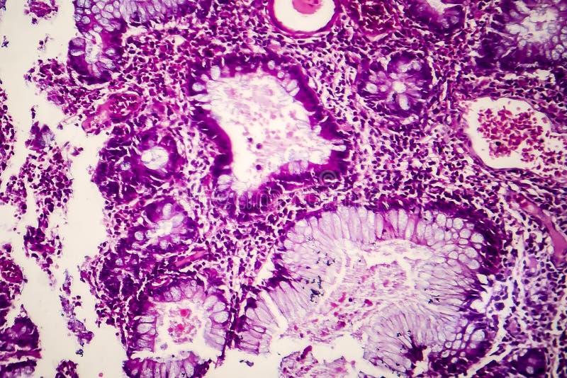 Villous Colon Adenocarcinoma, Light Micrograph Stock Image - Image of ...
