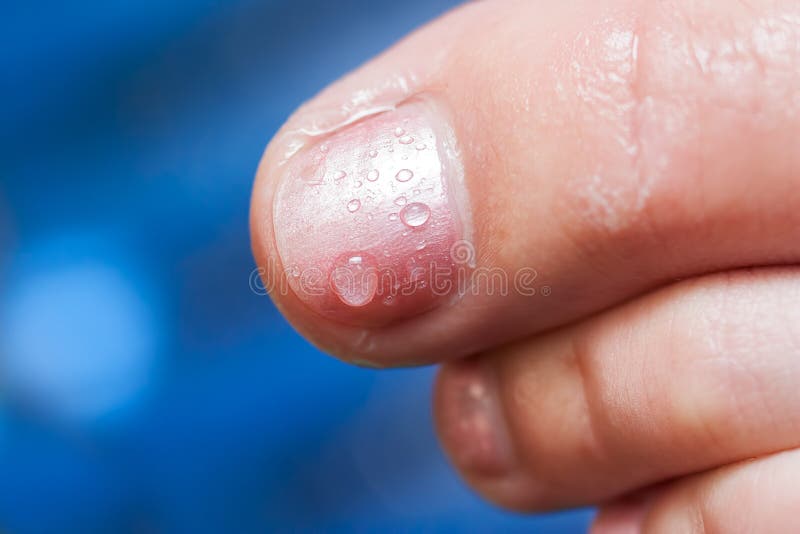 Gebeten Vingernagels stock afbeelding. Image of zorg - 33930275