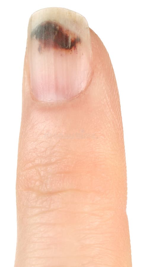 Hematoom stock foto. Image of medisch, huid, trauma, pijnlijk - 24736464