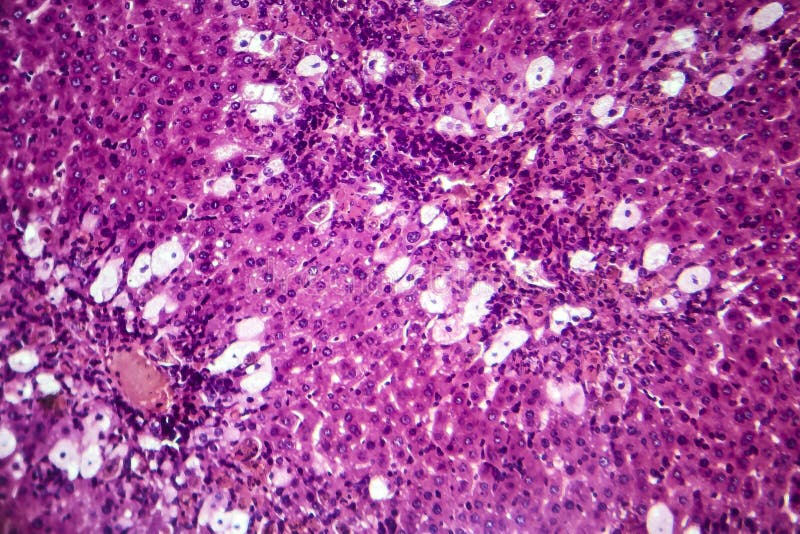 Viral Hepatitis, Light Micrograph Stock Illustration - Illustration of ...