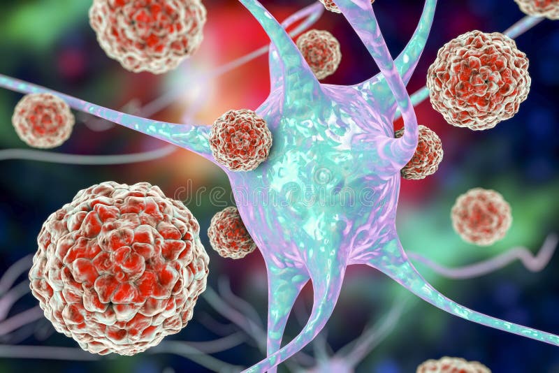 Brain infection stock illustration. Illustration of bacteria - 8692484