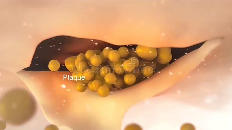 Visible Plaque Stock Illustrations – 11 Visible Plaque Stock ...