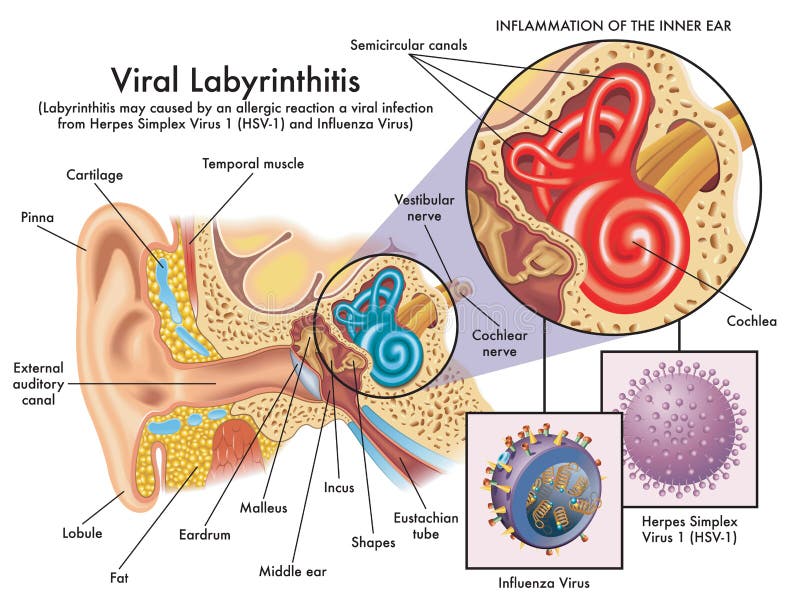 Viren-labyrinthitis Illustration Vektor Abbildung - Illustration von ...