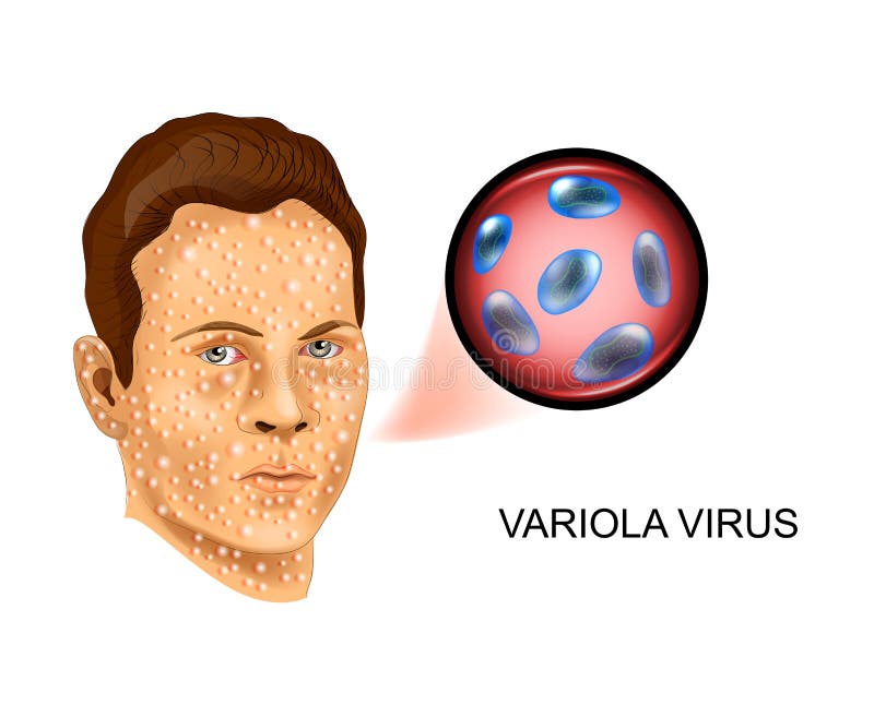Vaiolo, virus di vaiolo, illustrazione vettoriale. Illustrazione di ...