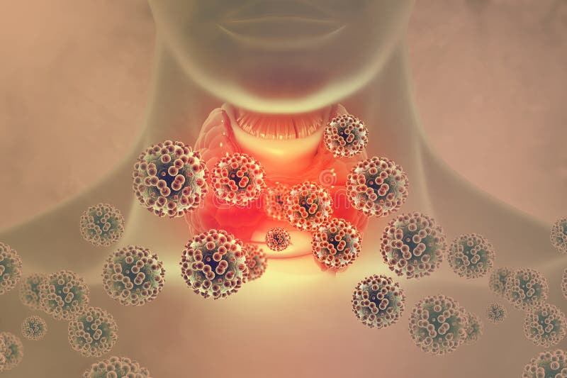 Thyroid Gland Cancer. Showing Thyroid Gland with Tumor Stock Photo ...