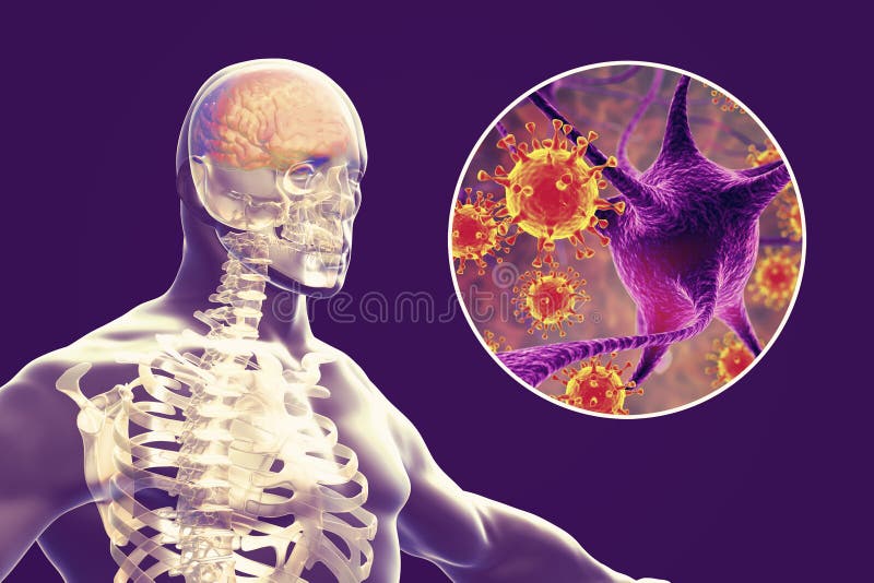 Virus- Meningit Och Encefalit, Medicinskt Begrepp Stock Illustrationer ...