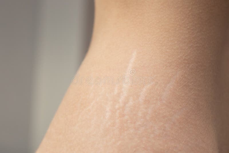 107 Stretch Marks Muscle Stock Photos - Free & Royalty-Free Stock ...